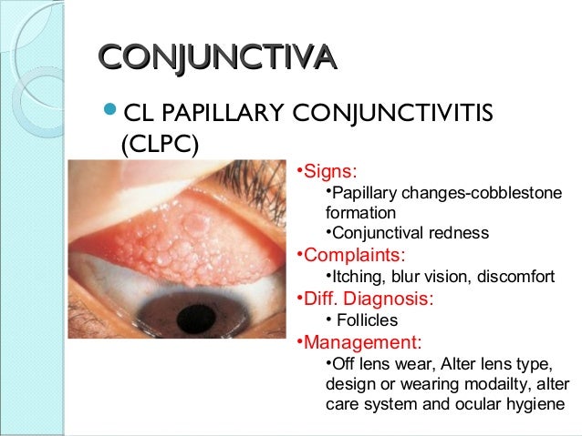 Contact lens complication