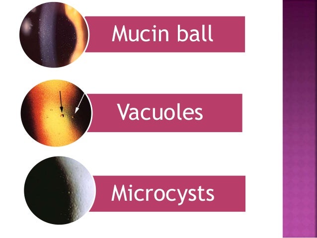 Contact Lens Complications-P82502