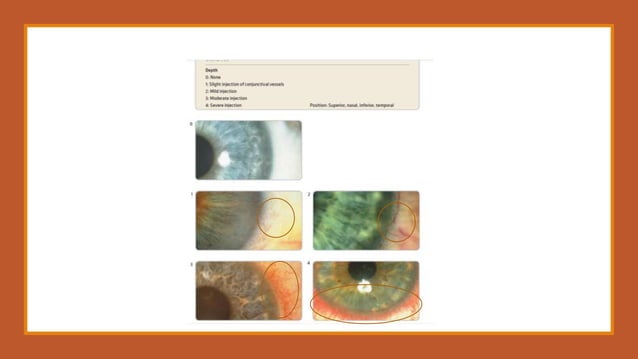 Soft & RGP Contact lens complications.pptx | Eye and Vision Conditions | Diseases and Conditions