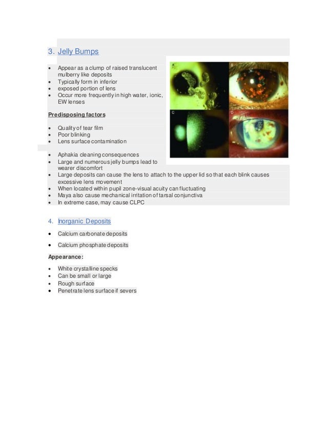 Contact Lens Deposits, Contact lens Aftercare, Overview of care and ...