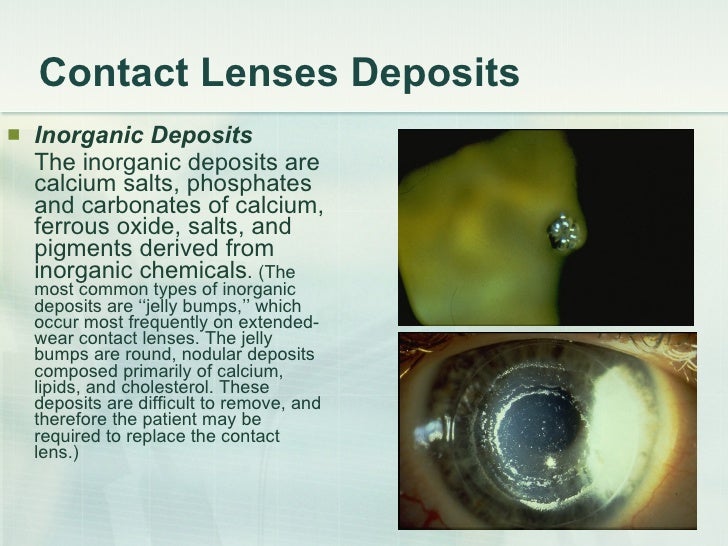 Contact Lenses