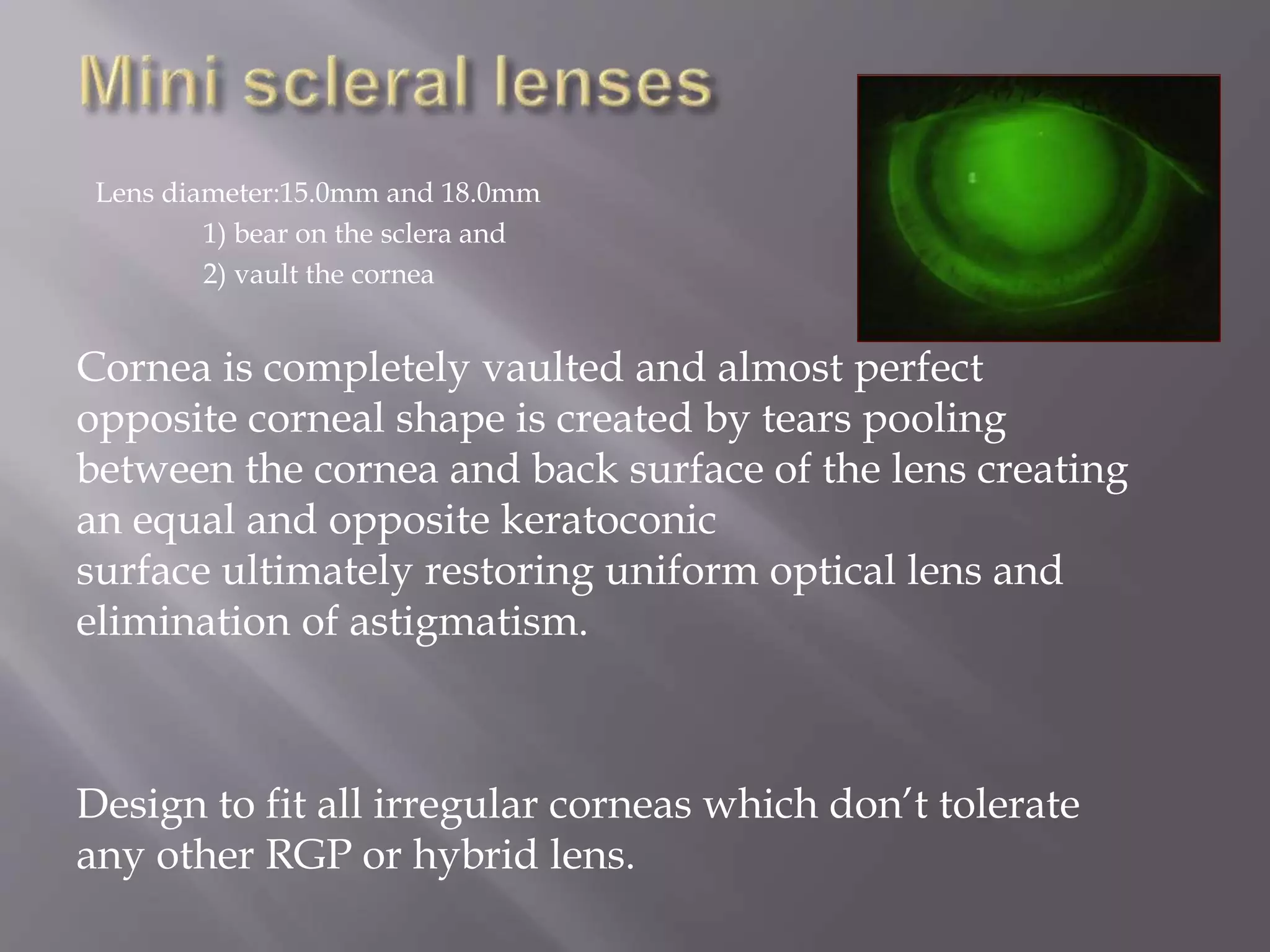 Contact lens fitting in keratoconus copy | PPTX