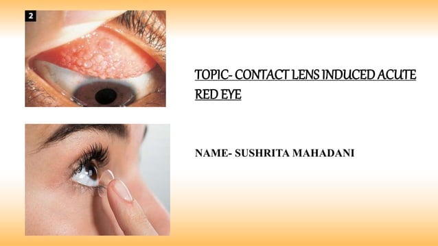 CONTACT LENS INDUCED ACUTE RED EYE.pptx