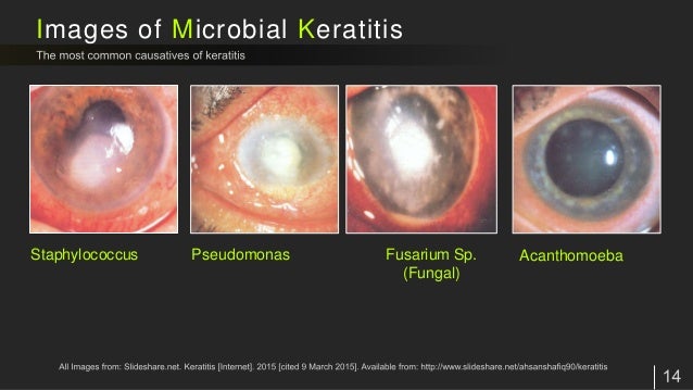 Contact lens infection presentation