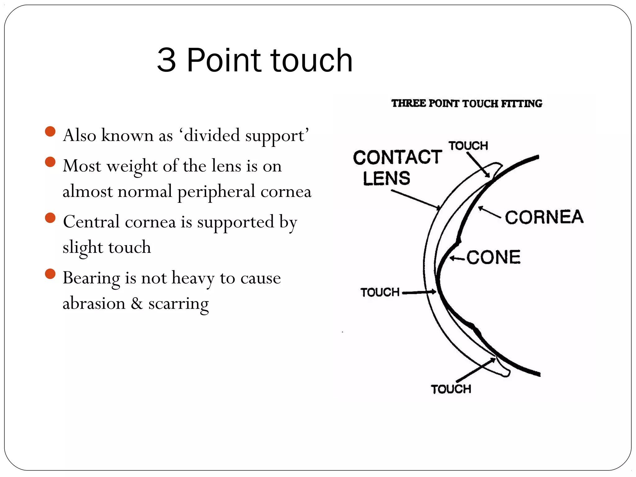 Contact lens in keratoconus | PPT