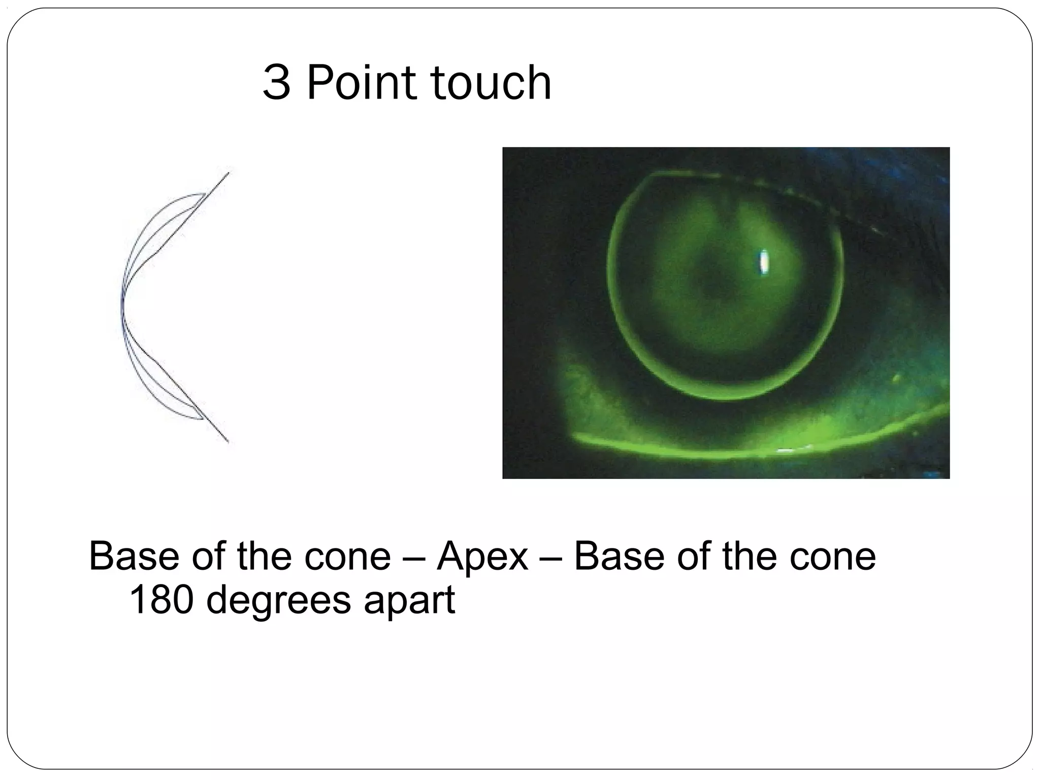 Contact lens in keratoconus | PPT