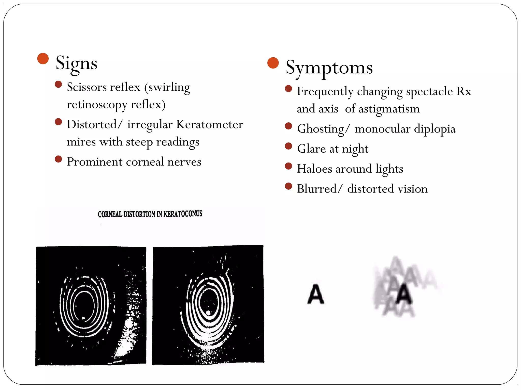 Contact lens in keratoconus | PPT