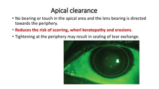 Contact lens in keratoconus 2 | PPTX