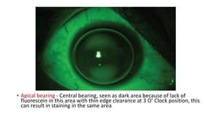 Contact lens in keratoconus 2 | PPTX