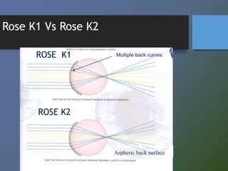 Contact lens options in keratoconus hira | PPTX