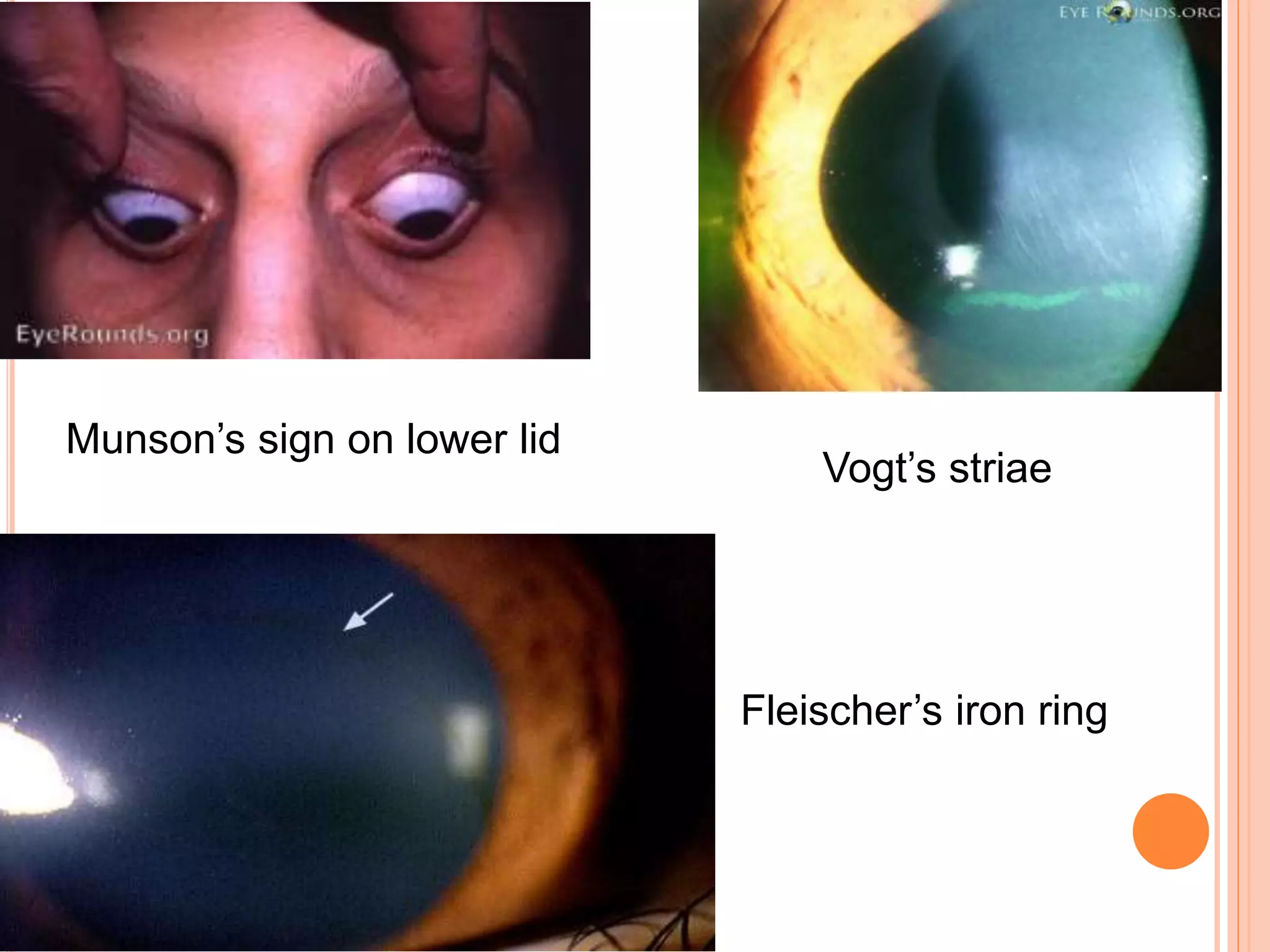 Contact Lens Options In Keratoconus Patients | PPTX