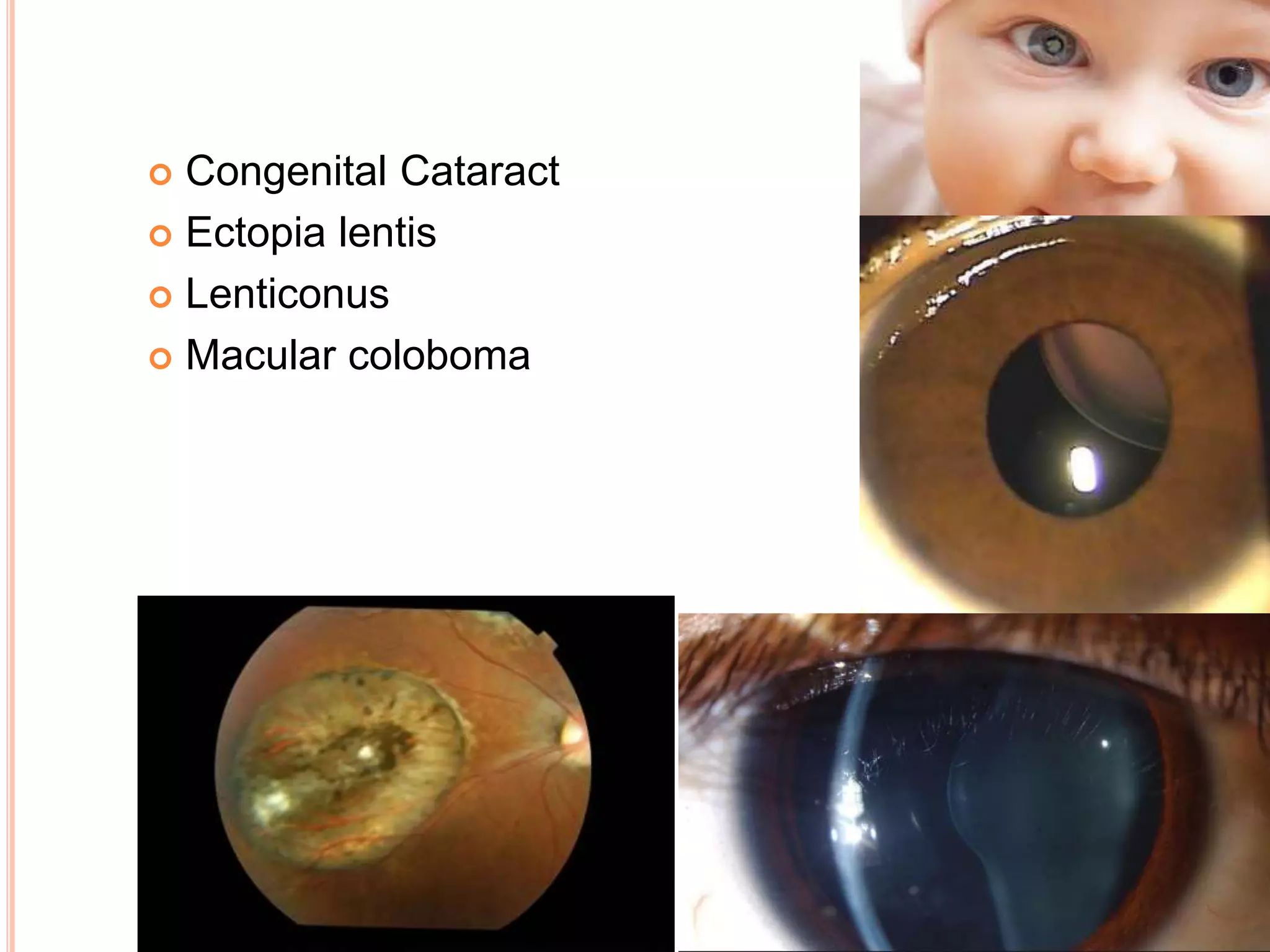 Contact Lens Options In Keratoconus Patients | PPTX