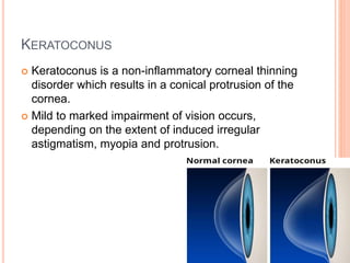 Contact Lens Options In Keratoconus Patients | PPTX
