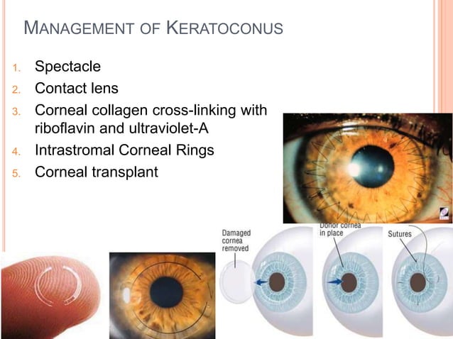 Contact Lens Options In Keratoconus Patients | PPTX | Eye and Vision ...