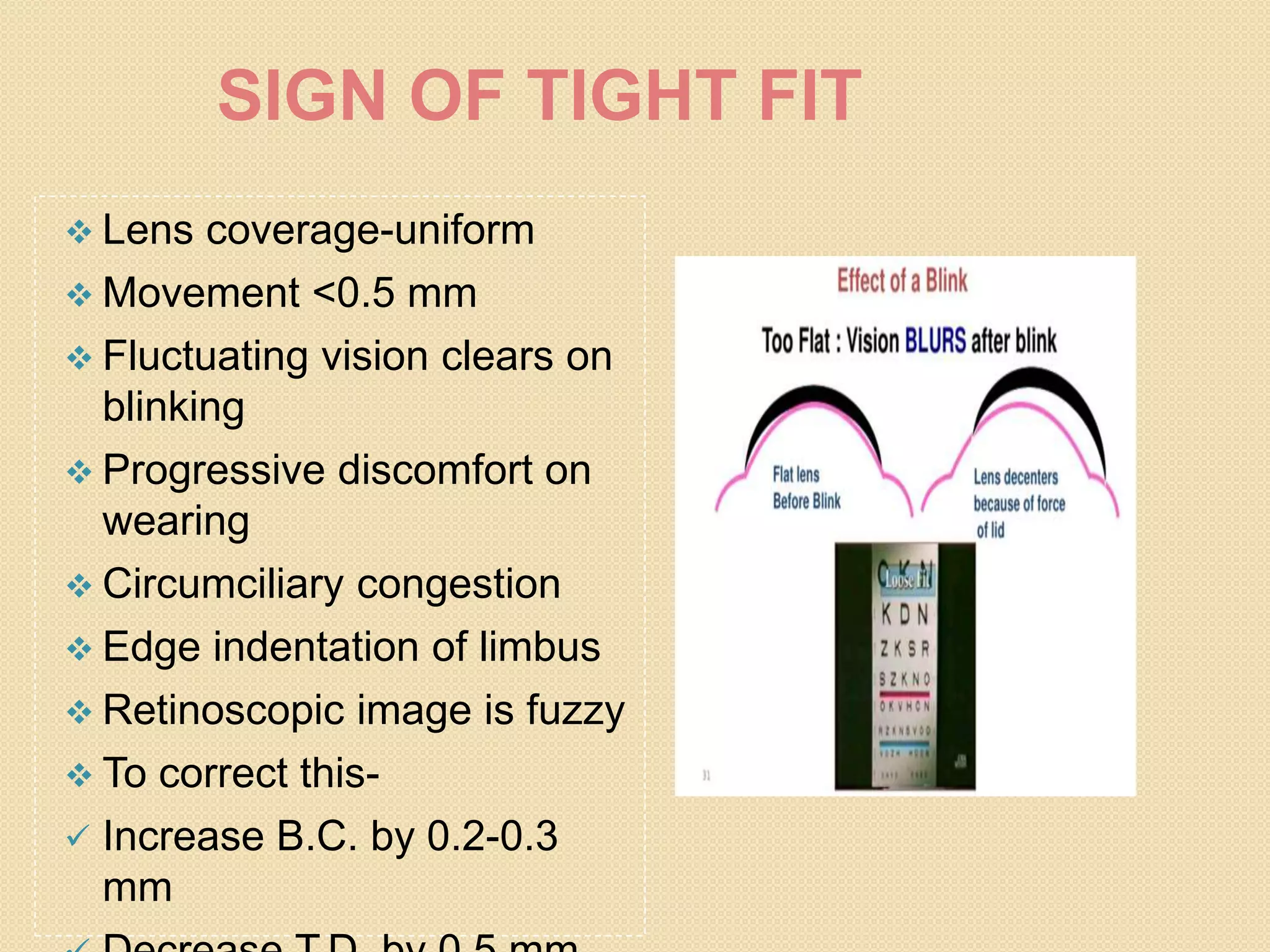 Contact lenses in Ophthalmology | PPT