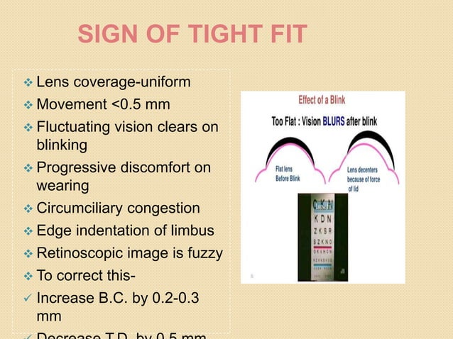 Contact lenses in Ophthalmology | PPTX