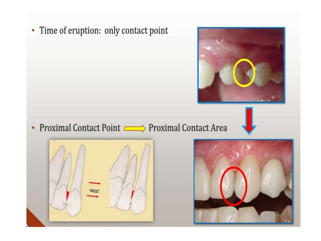 Contacts and Contours | PPTX | Dental Health | Diseases and Conditions