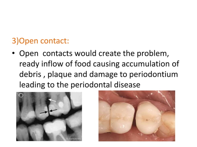 Contacts and Contours | PPTX | Dental Health | Diseases and Conditions