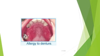 Contact stomatitis and dermatitis | PPTX