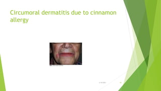 Contact stomatitis and dermatitis | PPTX