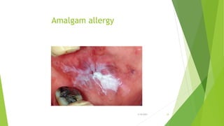 Contact stomatitis and dermatitis | PPTX