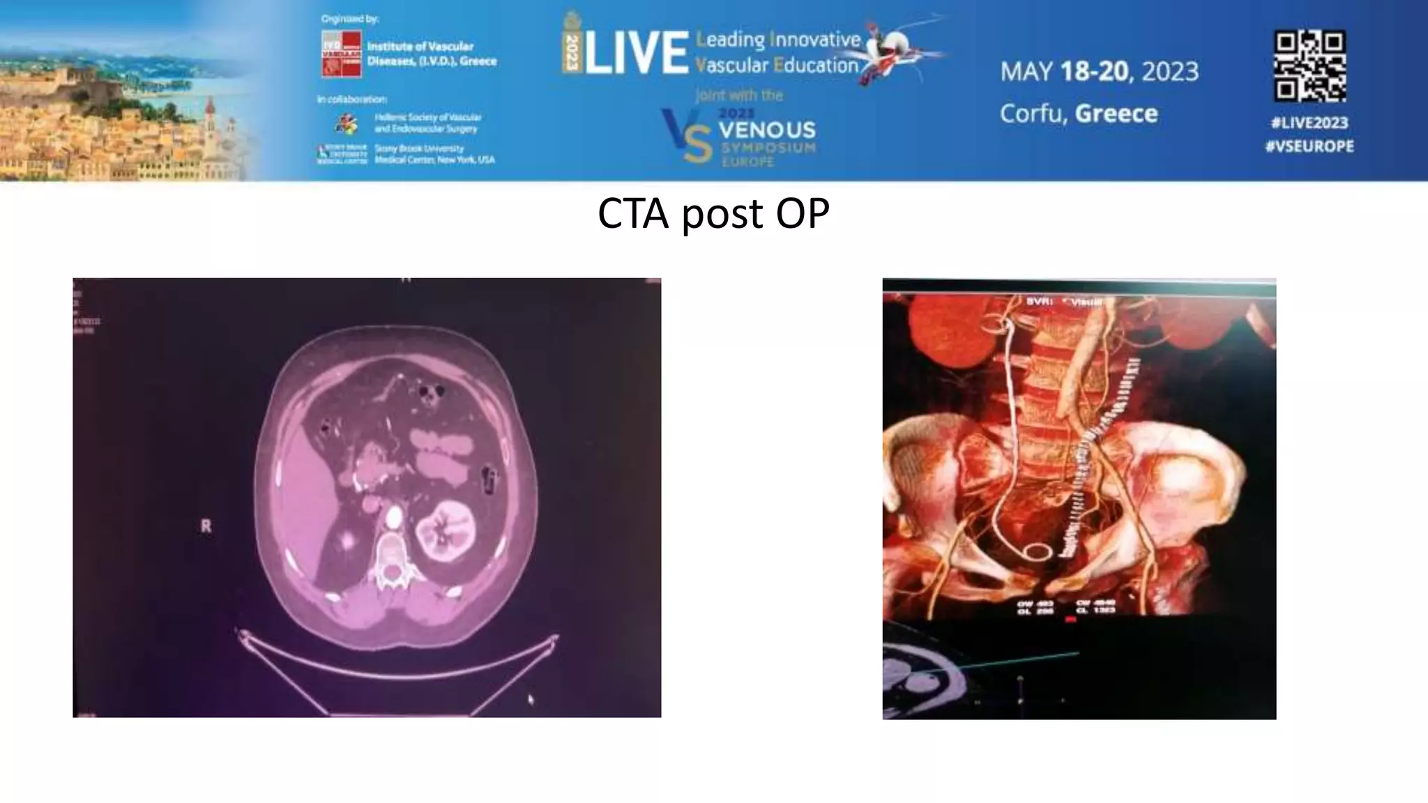 Contained Rupture of Common Iliac Artery, Concomitant with ...