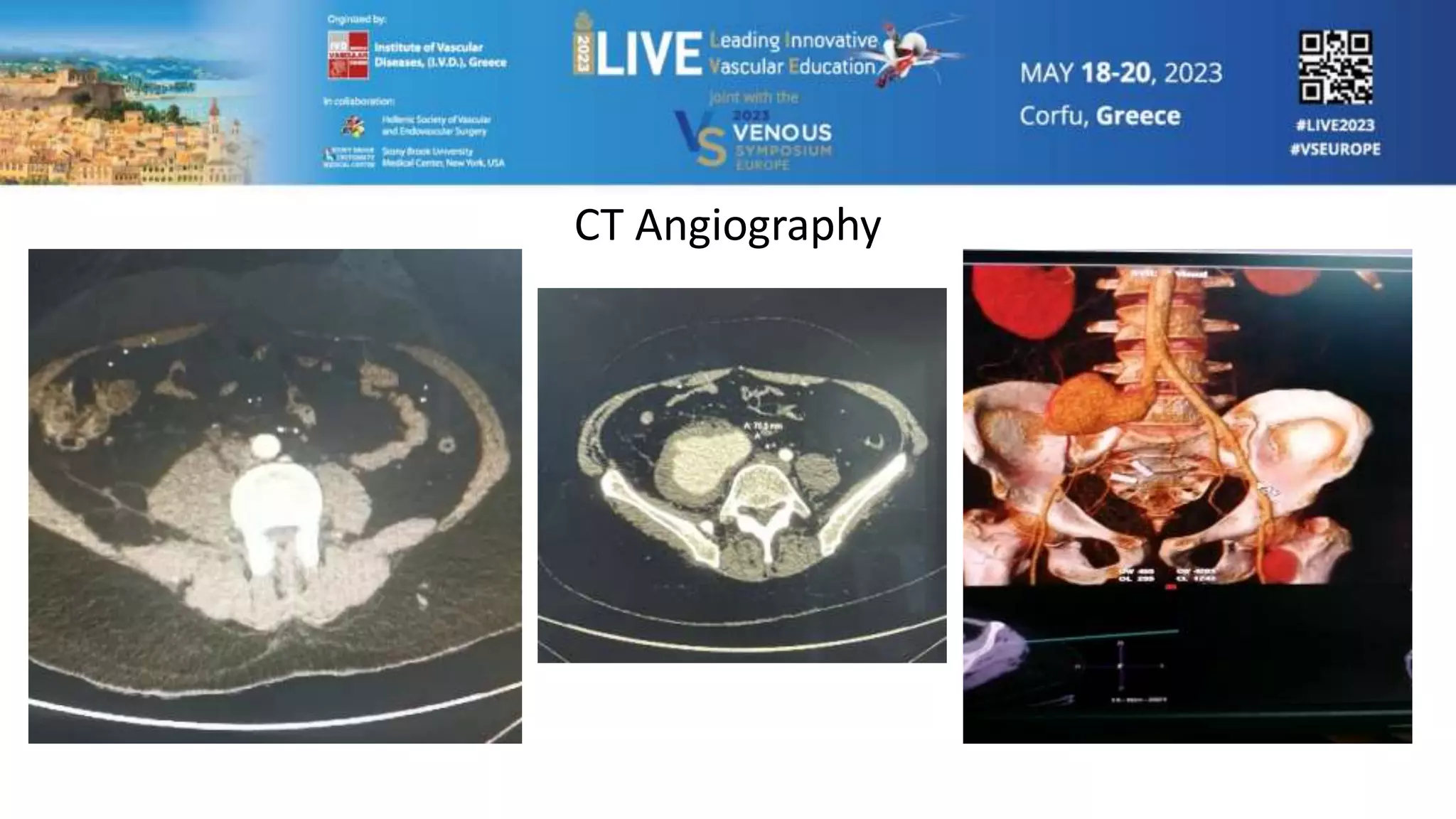 Contained Rupture of Common Iliac Artery, Concomitant with ...