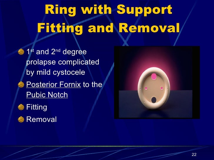 Contemporary Use of the Pessary