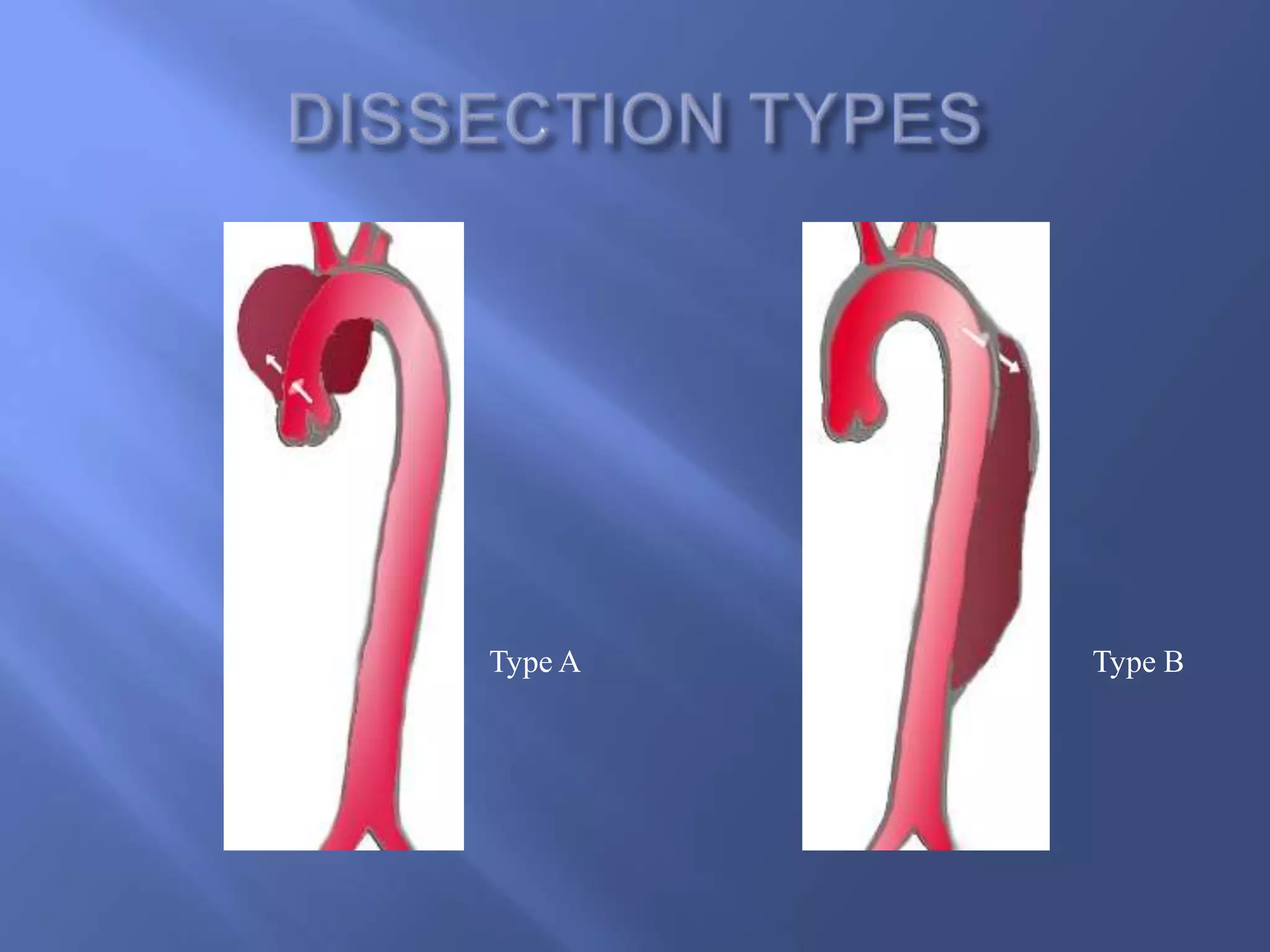 Contemporary management of acute type b aortic dissections | PPTX