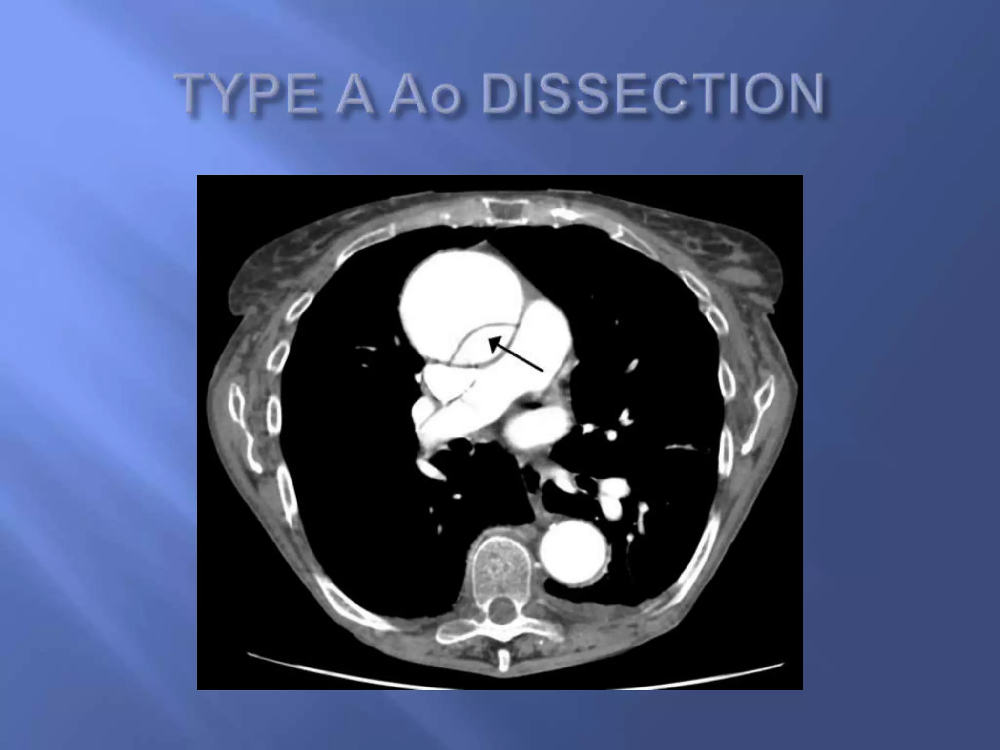 Contemporary management of acute type b aortic dissections | PPTX