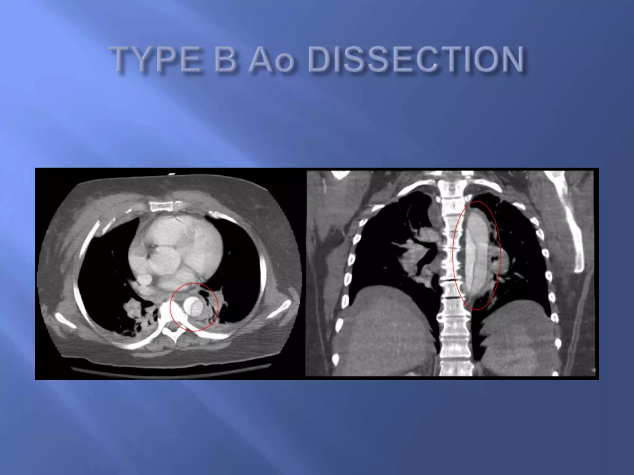 Contemporary management of acute type b aortic dissections | PPTX