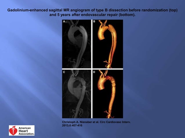 Contemporary management of acute type b aortic dissections | PPTX