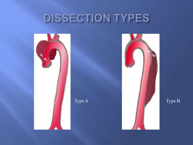 Contemporary management of acute type b aortic dissections | PPTX