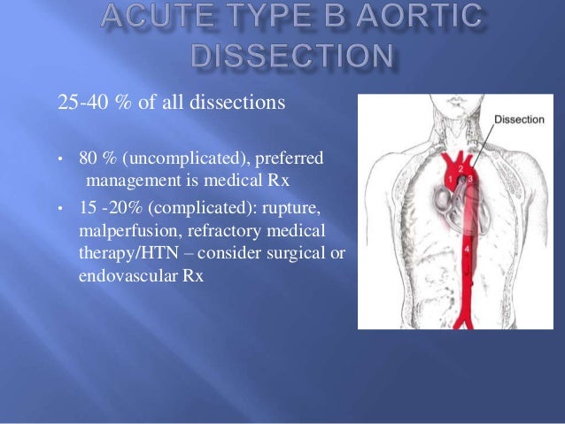 Contemporary management of acute type b aortic dissections