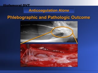 Contemporary management of iliofemoral venous thrombosis | PPT