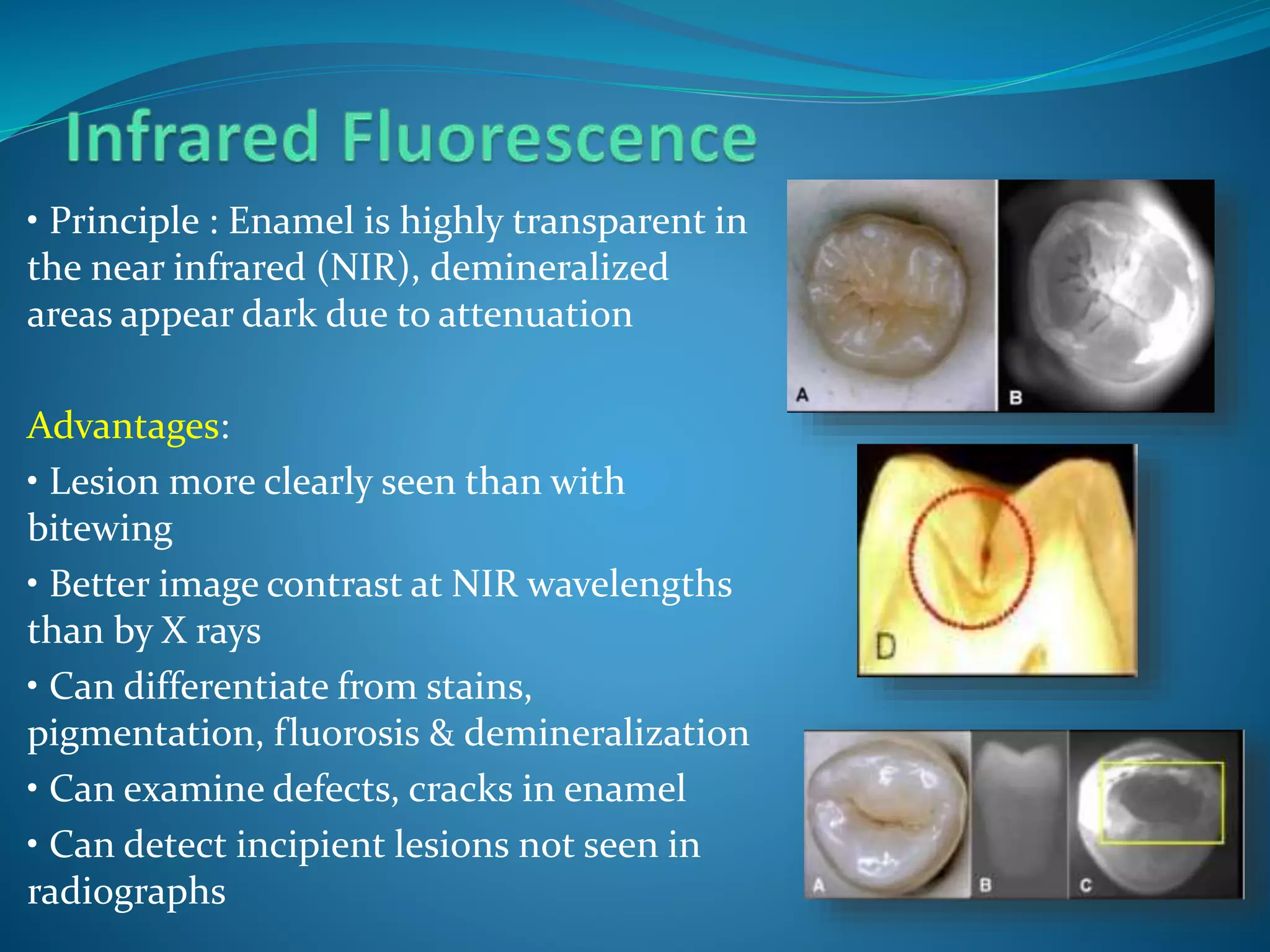 Contemporary Methods of Caries Detection | PPTX