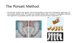 Contest doc 3d_printed_ponseti_cast | PPTX