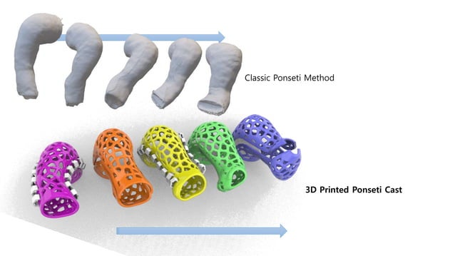 Contest doc 3d_printed_ponseti_cast | PPTX