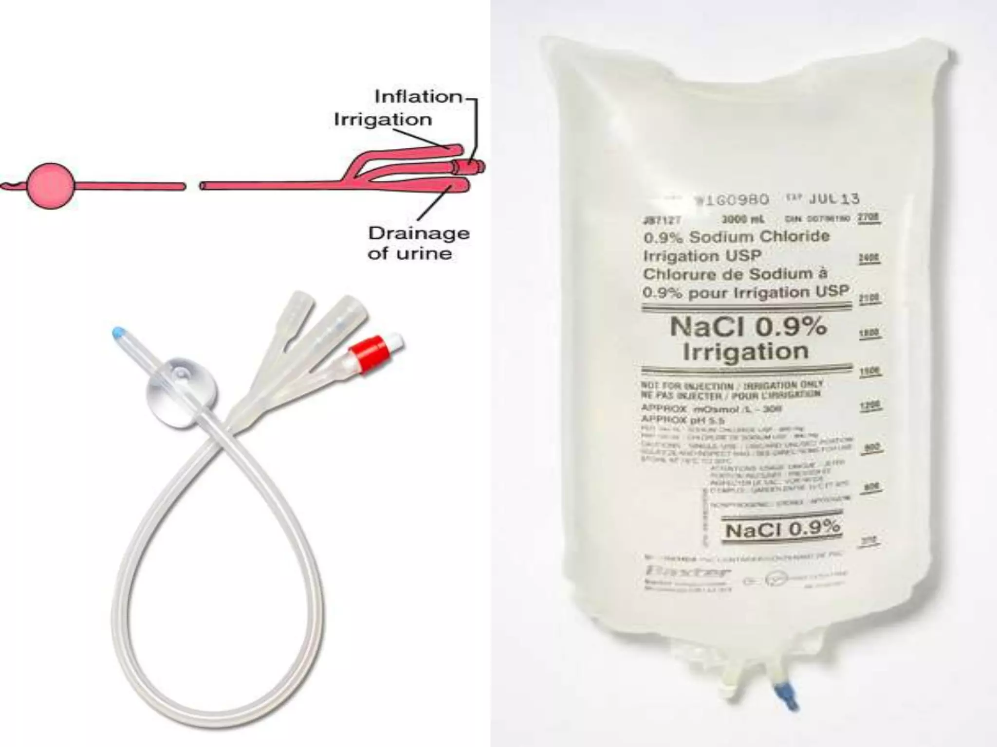 Continuous bladder irrigation | PPTX