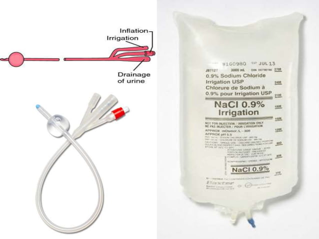 Continuous bladder irrigation | PPTX