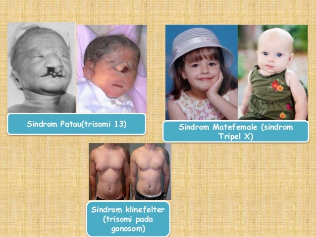 Contoh Penyakit Genetik - Homecare24