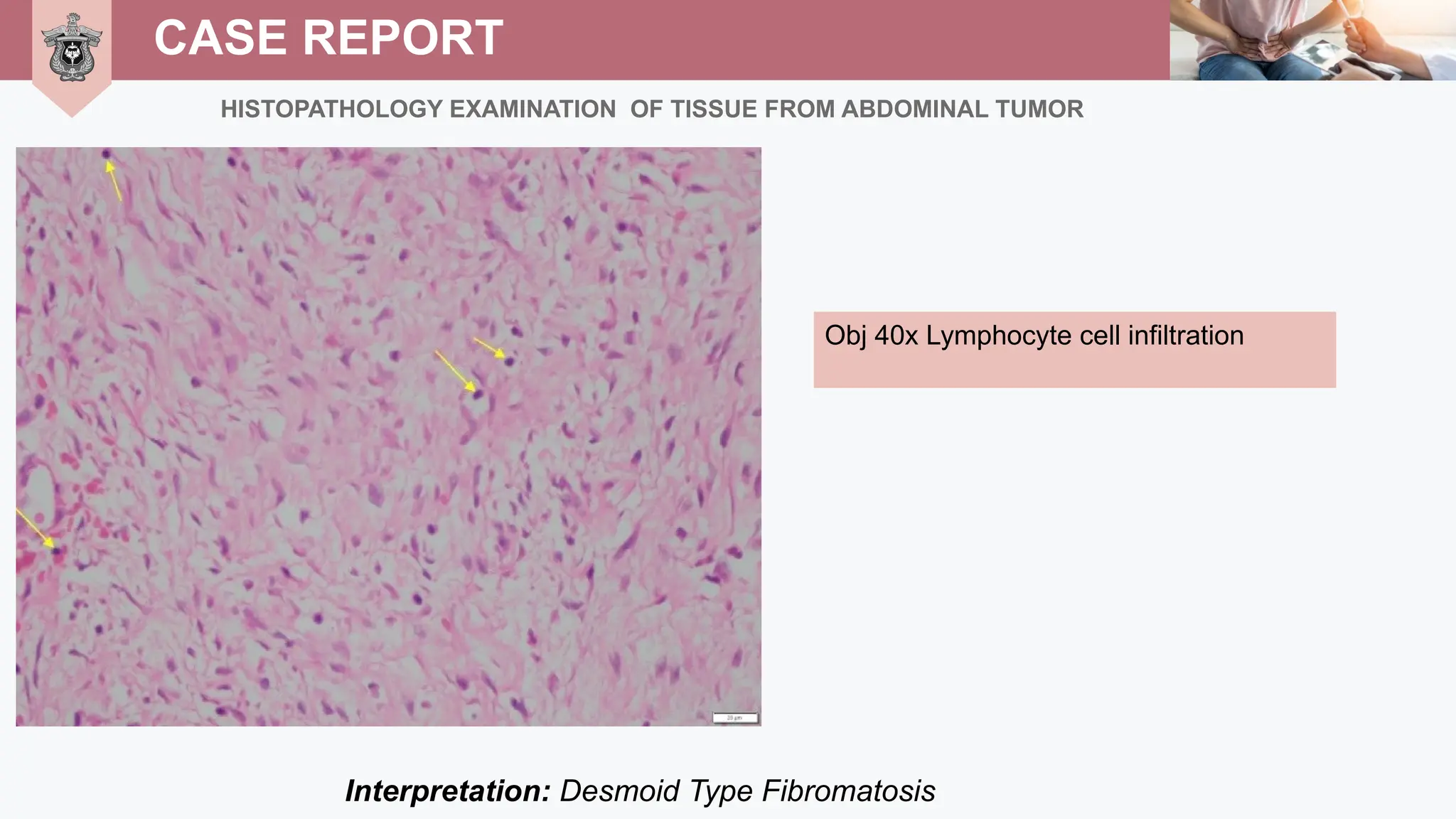 CONTOH Laporan kasus 18 tahun wanita dengan tumor intraabdomen | PPTX