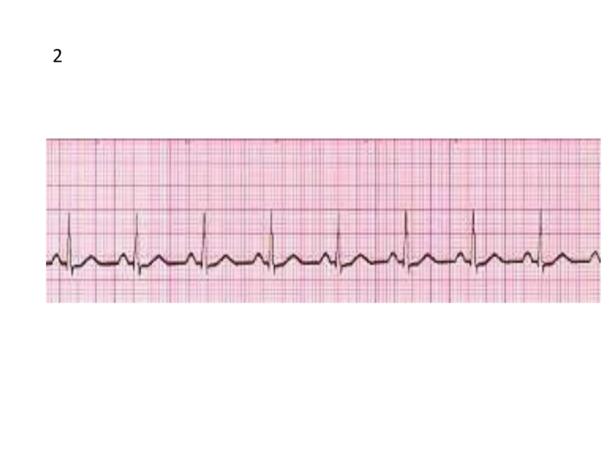 CONTOH SOALAN ECG yang selalu dijumpai di ED.pptx