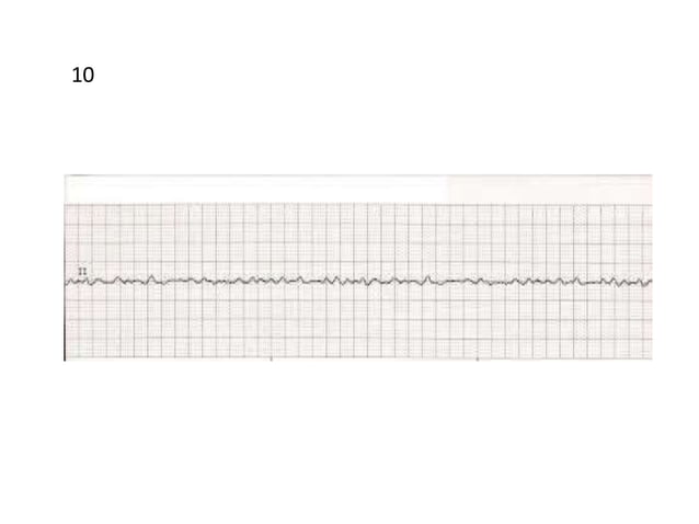 CONTOH SOALAN ECG yang selalu dijumpai di ED.pptx