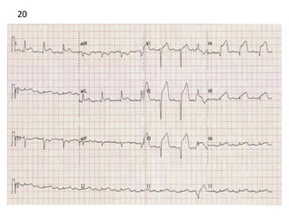 CONTOH SOALAN ECG yang selalu dijumpai di ED.pptx
