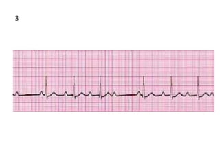CONTOH SOALAN ECG yang selalu dijumpai di ED.pptx