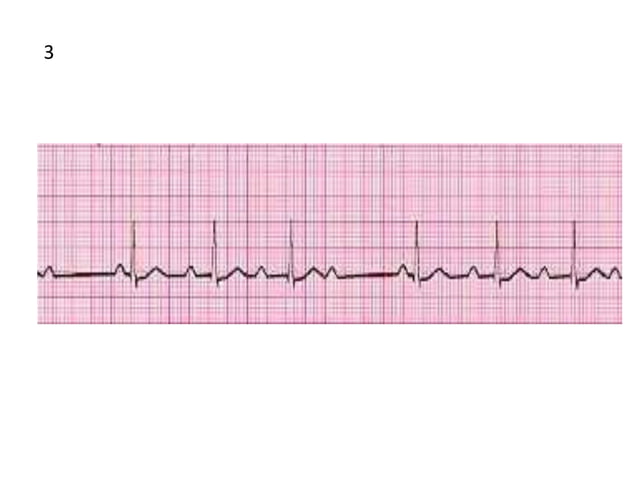CONTOH SOALAN ECG yang selalu dijumpai di ED.pptx