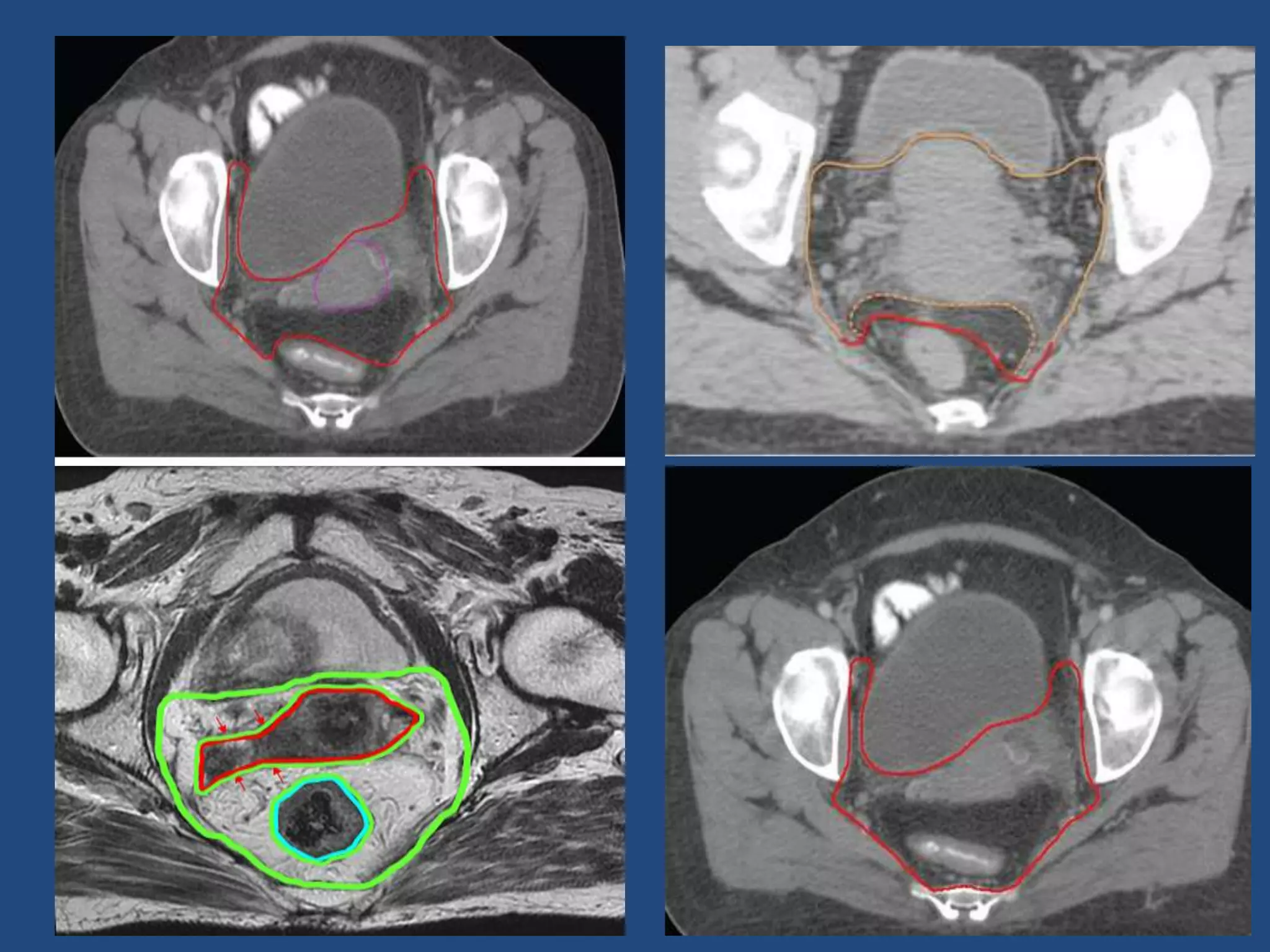 Contouring guidelines Cervix IMRT | PPTX