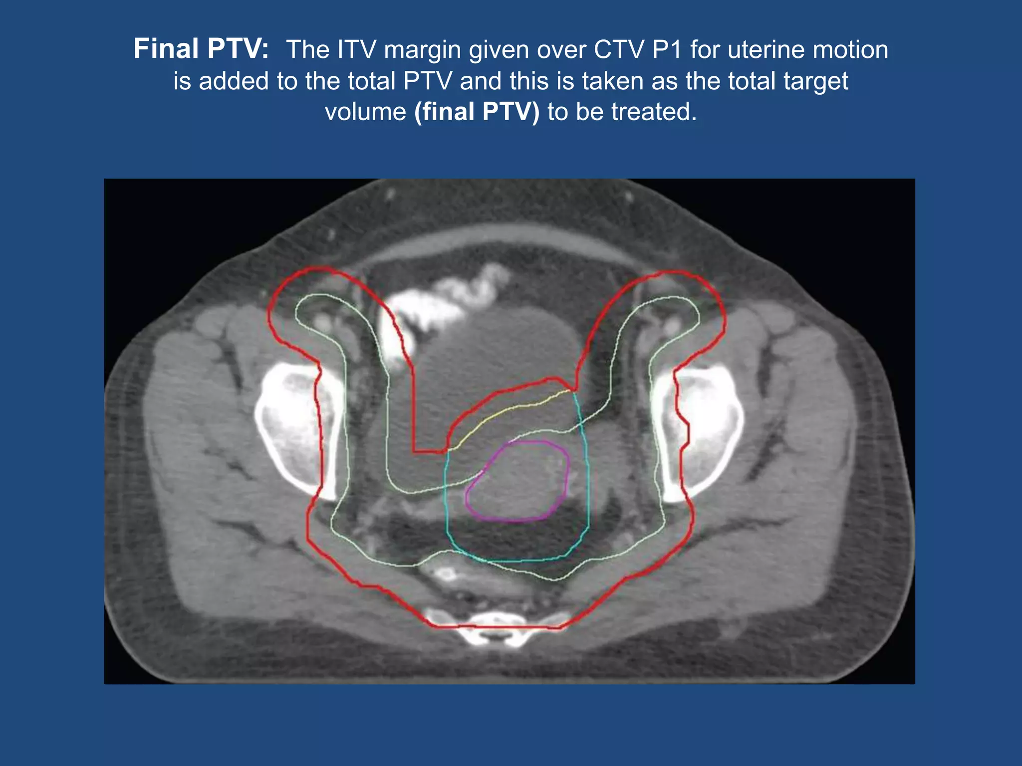 Contouring guidelines Cervix IMRT | PPTX