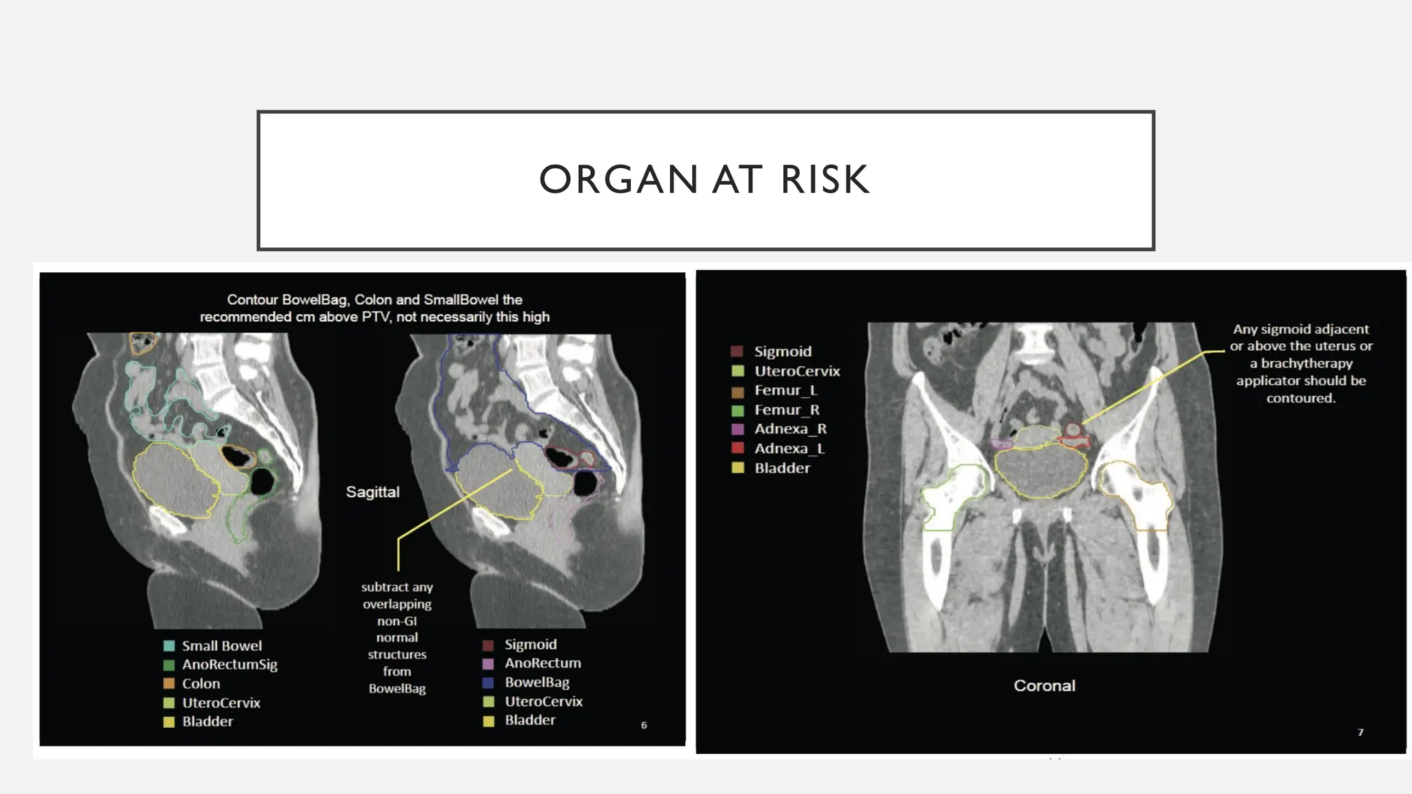 contouring guidelines ca cervix.pdf